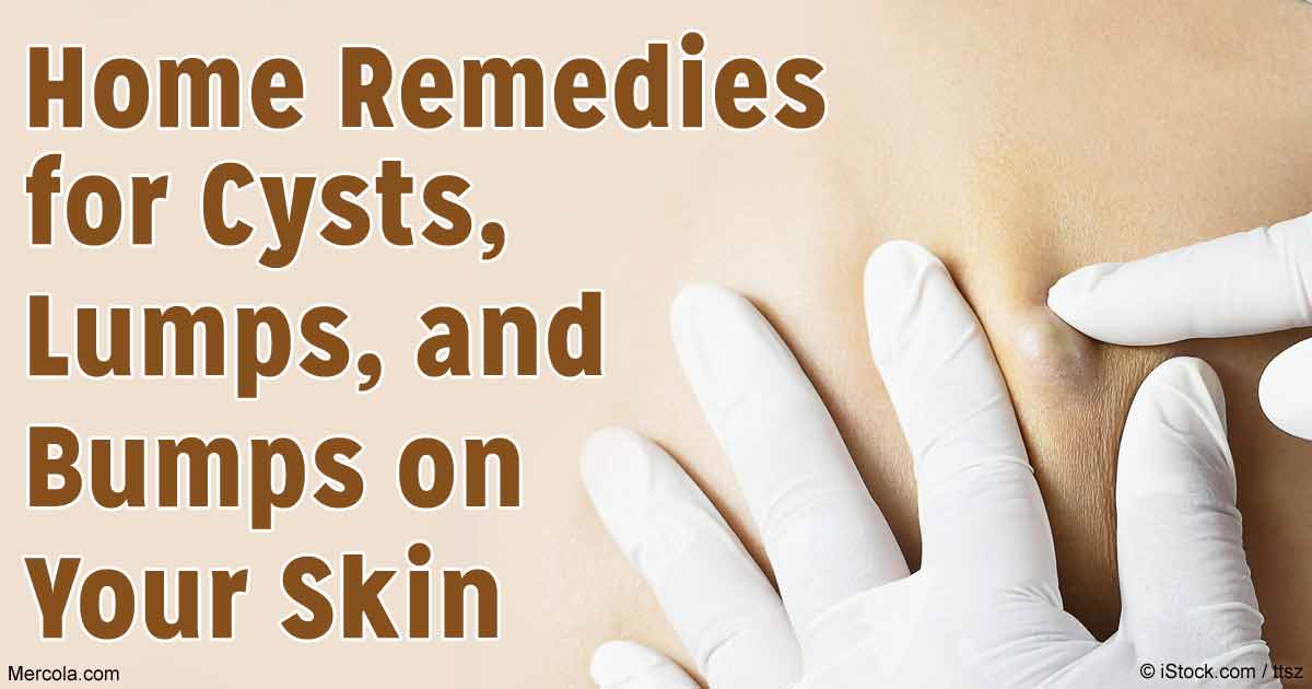 Lump On Scalp Under Skin Pictures Photos