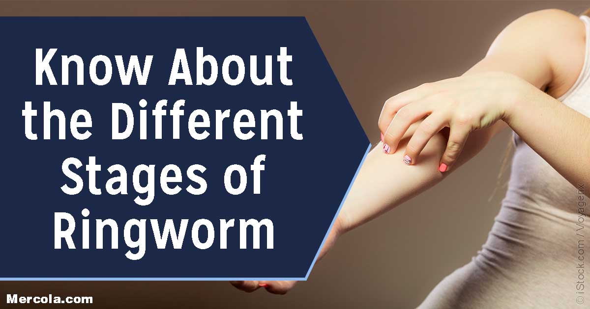The Different Stages Of Ringworm The Different Stages Of Ringworm