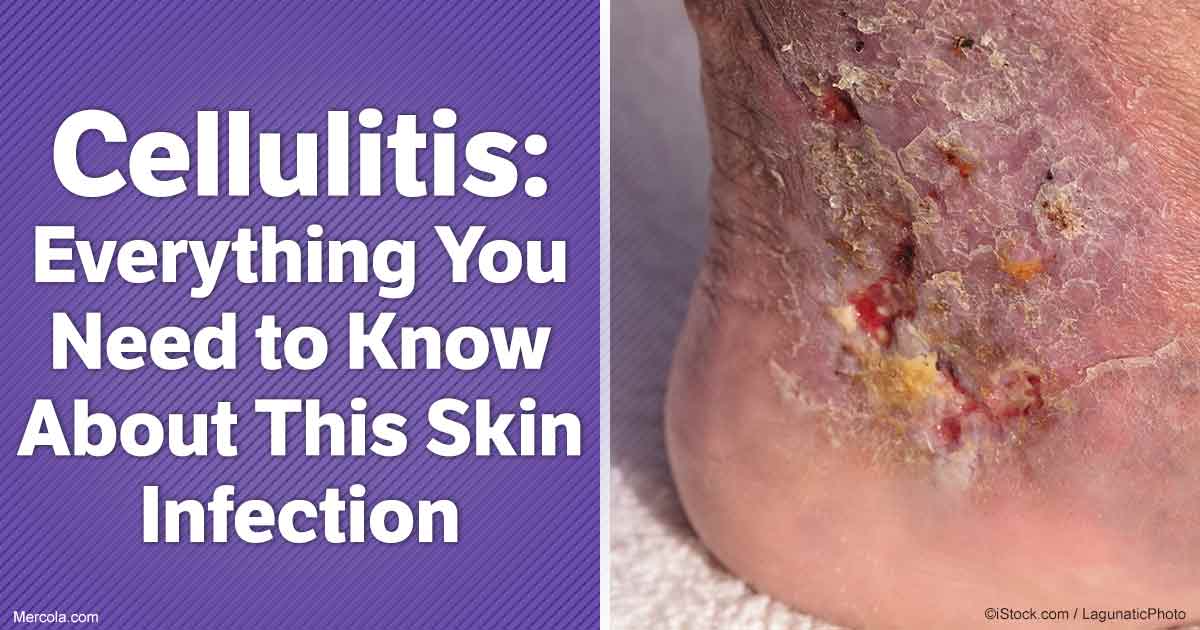 Cellulitis Infection Control Cellulitis Infection Control